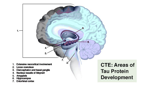 CTE: Areas of Tau Protein Development (diagram) - Elizabeth Sandel, M.D.